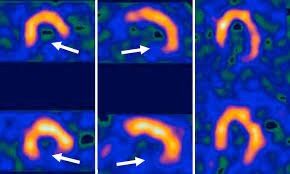 Resting Radionuclide Angiogram Test